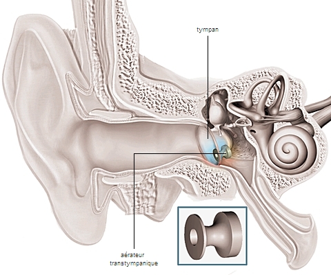 paracentèse - LAROUSSE