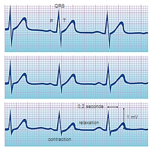 électrocardiographie ECG - LAROUSSE