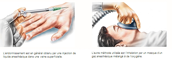 anesthésie générale - LAROUSSE